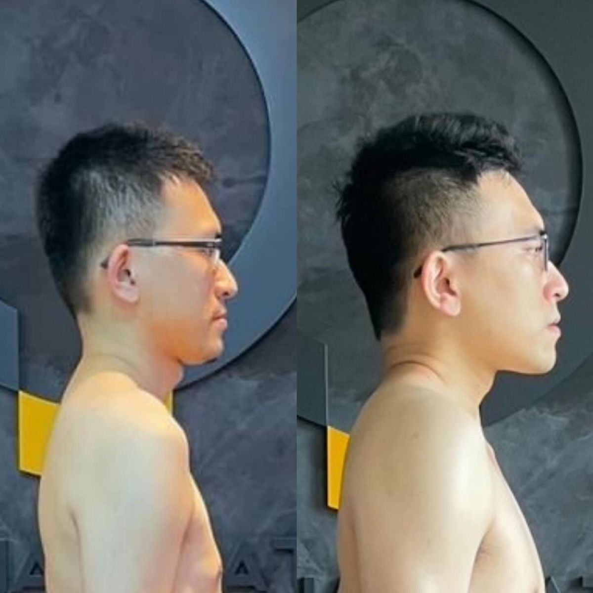 「脊椎側彎Scoliosis的運動方法-Part2 」 | Functional Patterns Taiwan